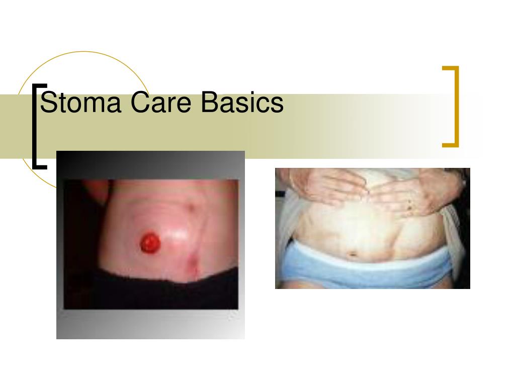 PPT - Stoma Care Basics PowerPoint Presentation, free download - ID:1055534