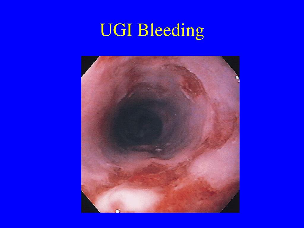 PPT - UGI Bleeding PowerPoint Presentation, free download - ID:1301848
