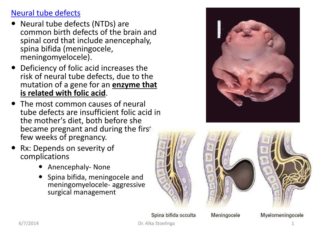 PPT - Neural tube defects PowerPoint Presentation, free download - ID ...