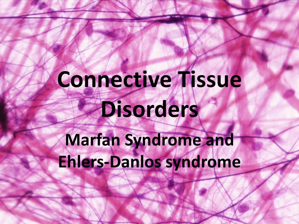 PPT - Connective Tissue Disorders: Marfan & Ehlers-Danlos Syndromes ...