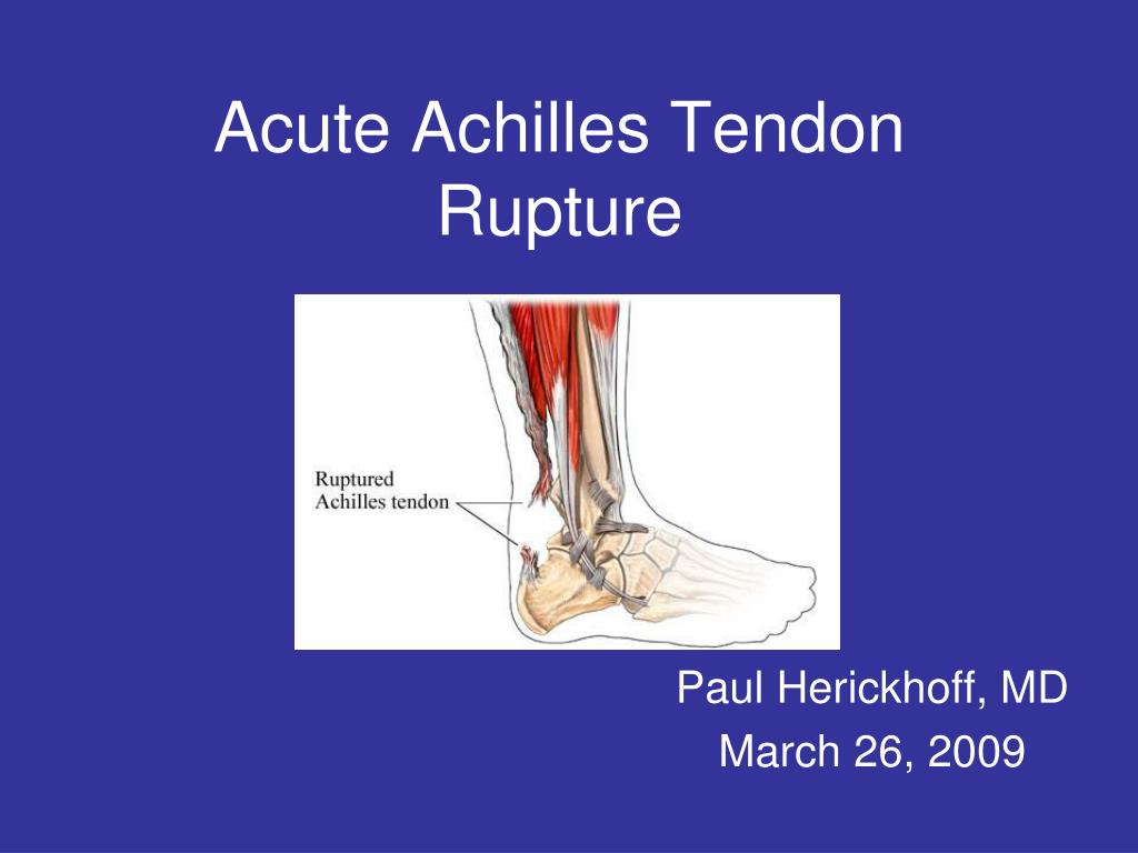 PPT - Acute Achilles Tendon Rupture PowerPoint Presentation, free ...
