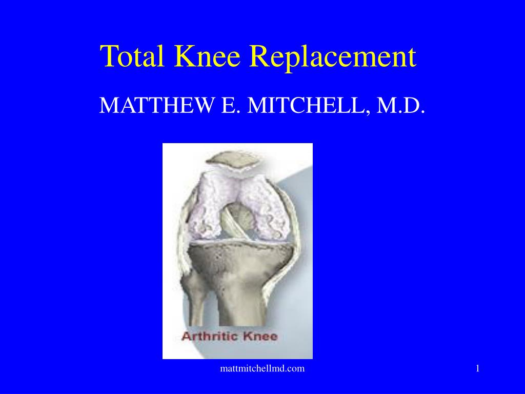 PPT - Total Knee Replacement PowerPoint Presentation, free download ...
