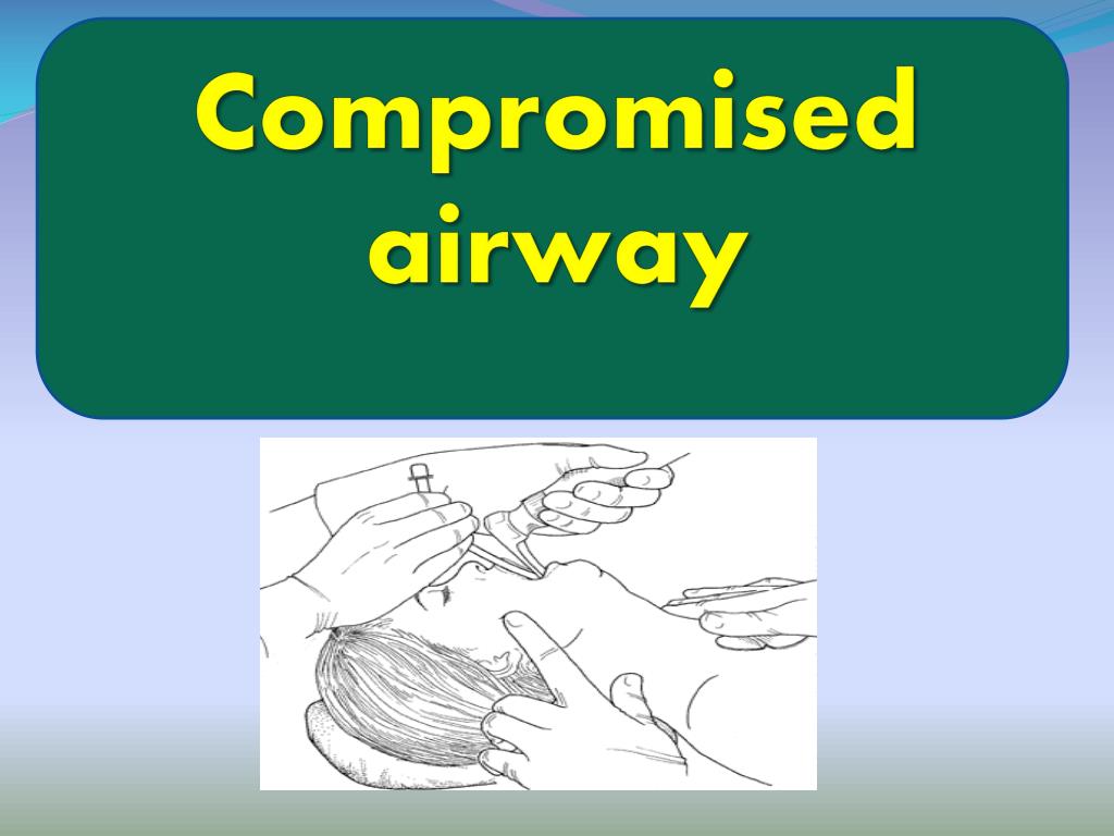 PPT - Compromised airway PowerPoint Presentation, free download - ID:257336