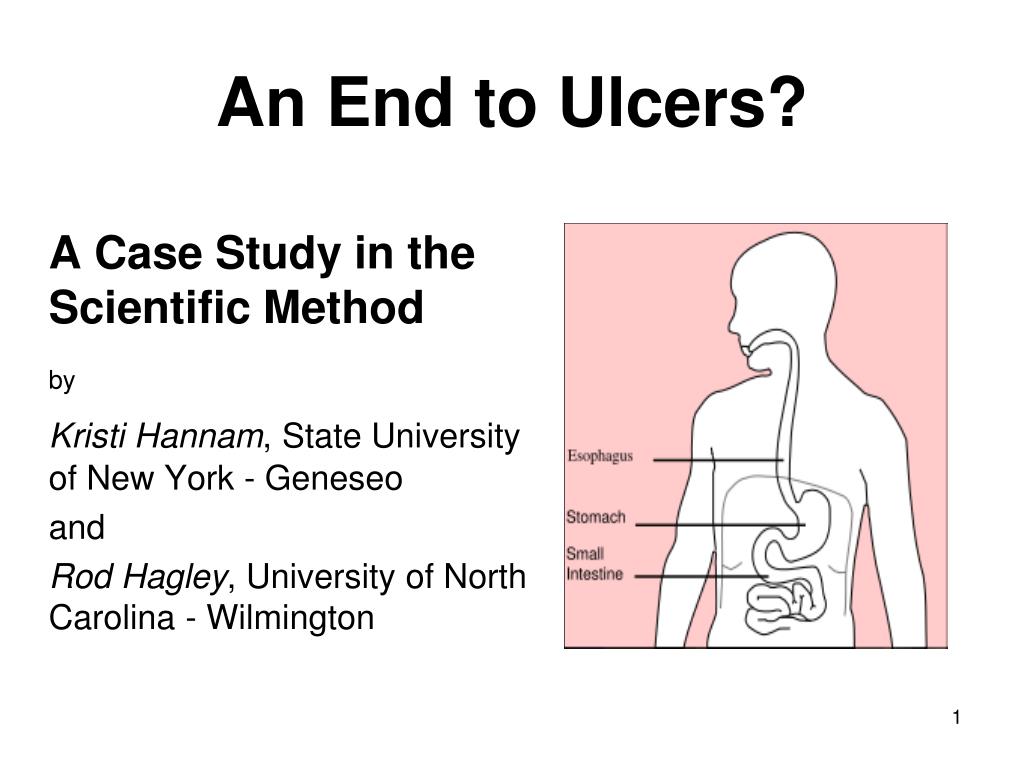 PPT - An End to Ulcers? PowerPoint Presentation, free download - ID:303258