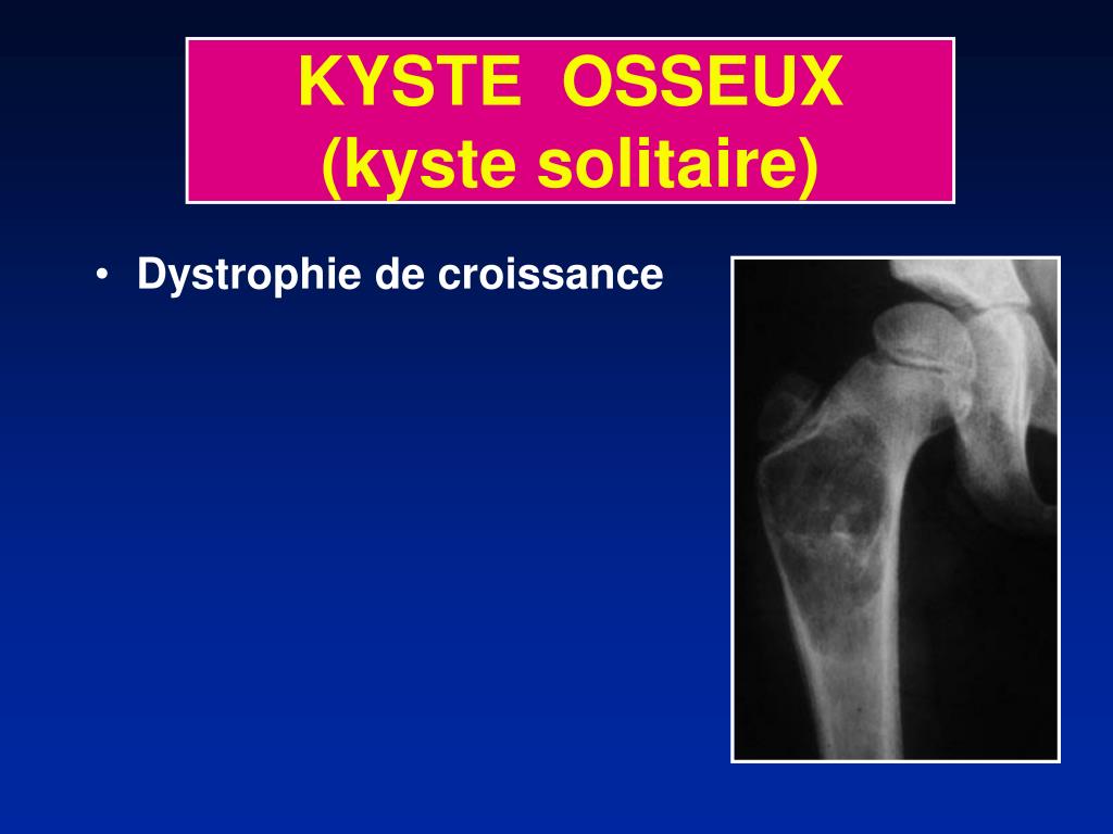 PPT - KYSTE OSSEUX (kyste solitaire) PowerPoint Presentation, free ...