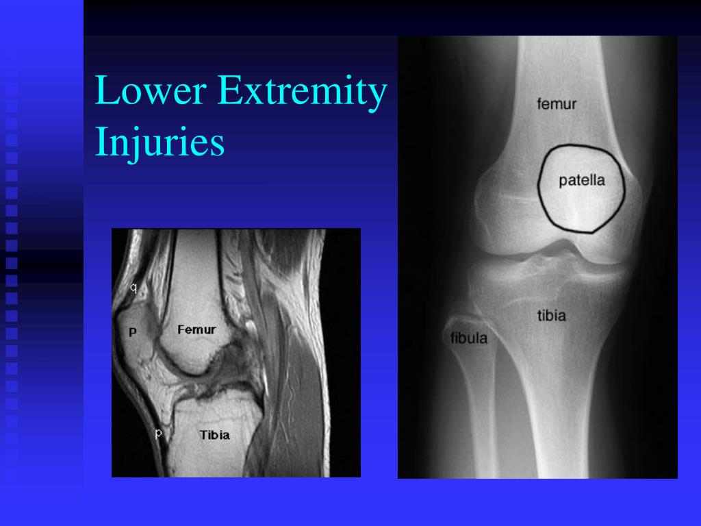 PPT - Lower Extremity Injuries PowerPoint Presentation, free download ...