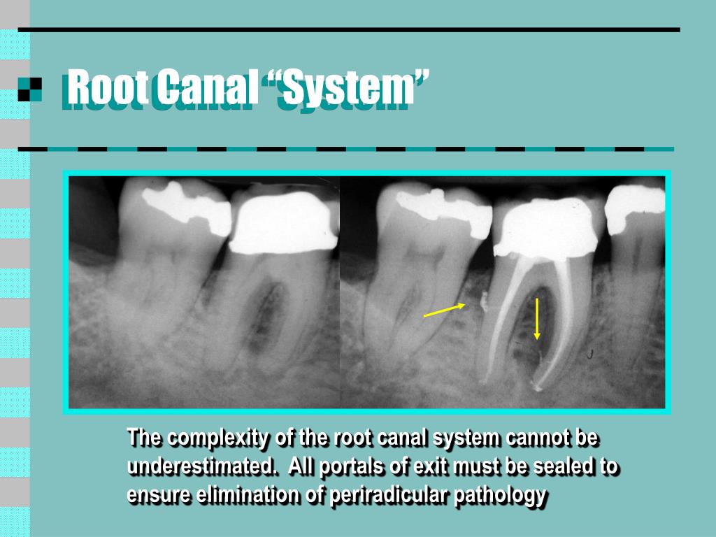 PPT - Root Canal “System” PowerPoint Presentation, free download - ID ...