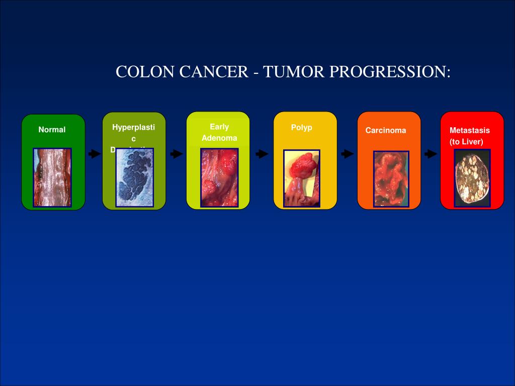PPT - Tumor progression PowerPoint Presentation, free download - ID:639814