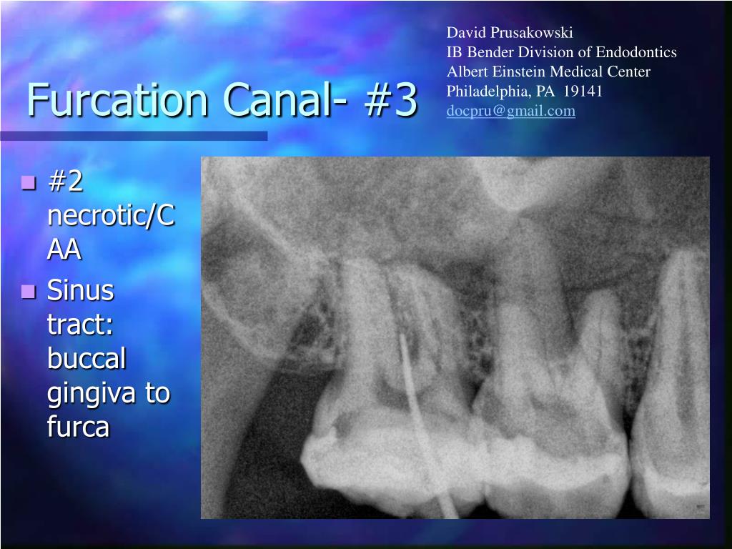PPT - Furcation Canal- #3 PowerPoint Presentation, free download - ID ...