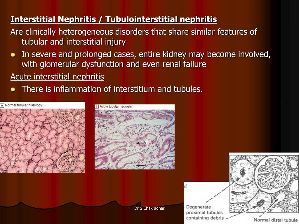 PPT - Interstitial Nephritis / Tubulointerstitial nephritis Are ...