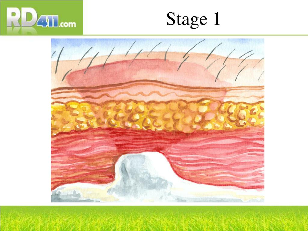 PPT - Understanding Deep Tissue Injuries: A Comprehensive Guide for ...