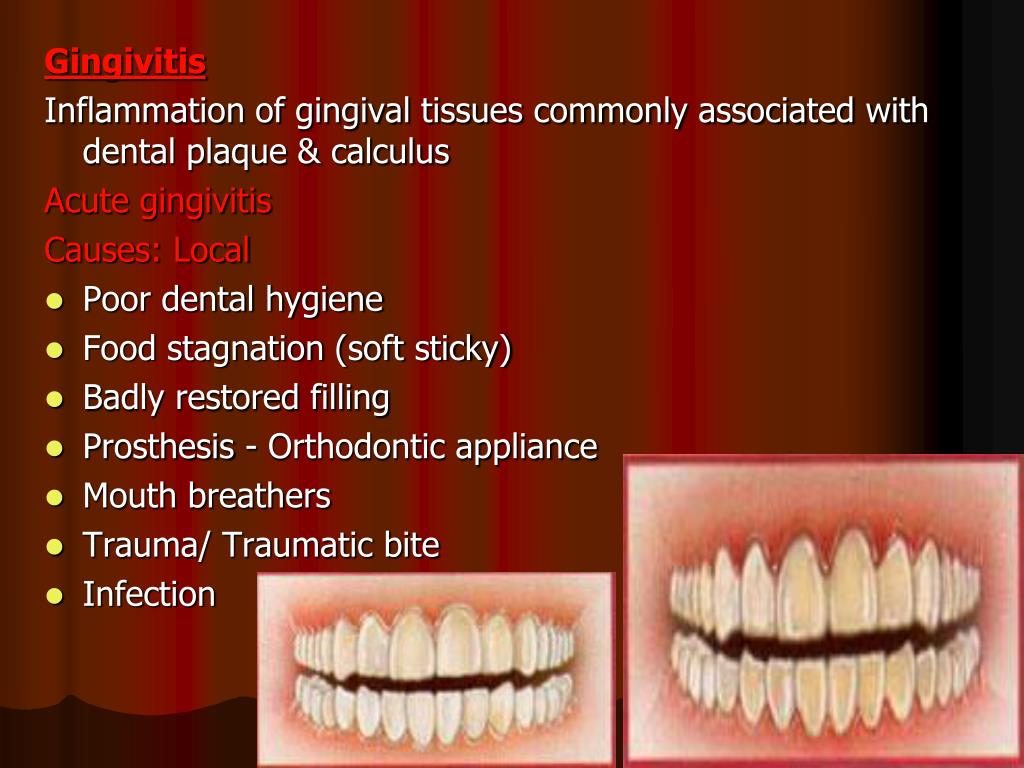 PPT - Gingivitis Inflammation of gingival tissues commonly associated ...
