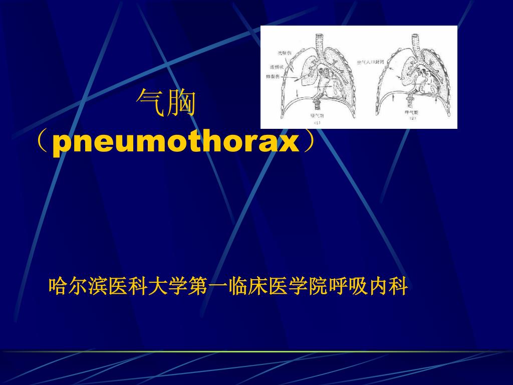 PPT - 气胸 （ pneumothorax ） PowerPoint Presentation, free download - ID ...