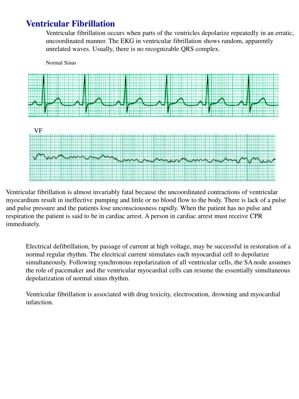 PPT - Ventricular Fibrillation PowerPoint Presentation, free download ...
